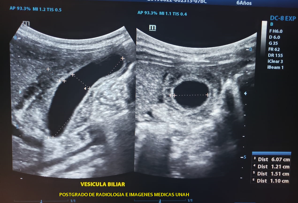 Poliserositis por Dengue.