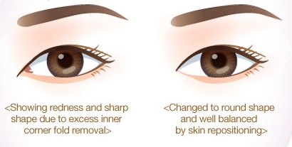 BK Plastic Surgery: [BK Plastic Surgery] Eyelid surgery: Inner Corner ...