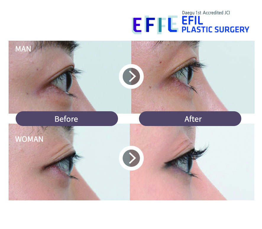 EFIL Bulging Eyes Plastic Surgery JCI