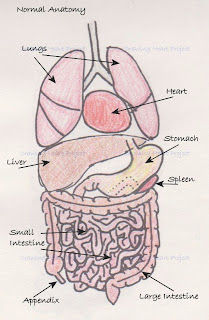 Drawing Heart: Heterotaxy RAI vs LAI