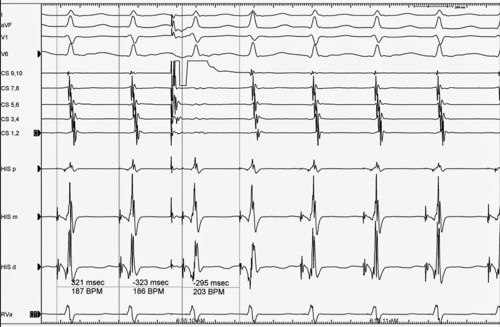 A Year at the Royal Brompton Hospital: Atrial extrastimuli, atrial ...