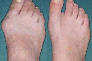 Get Rid Of This Bone Deformity Within 10 Days - Healthy tips