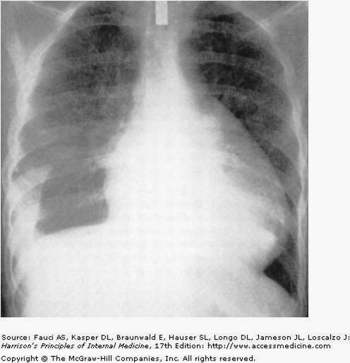CARDIOMEGALY | Kalangkang Mencrang