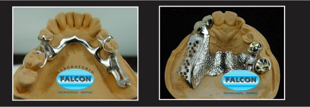 Laboratorio Dental Martin Falcon: PPR Metalicas