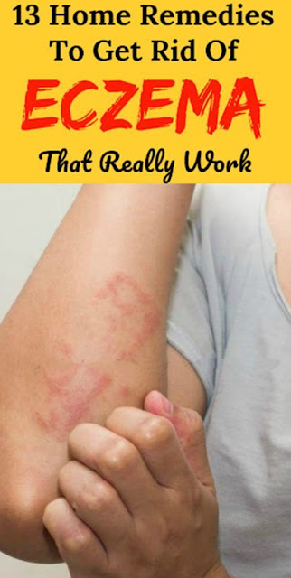 13 Home Remedies To Get Rid Of Eczema Fast That Really Work Wellness Magazine