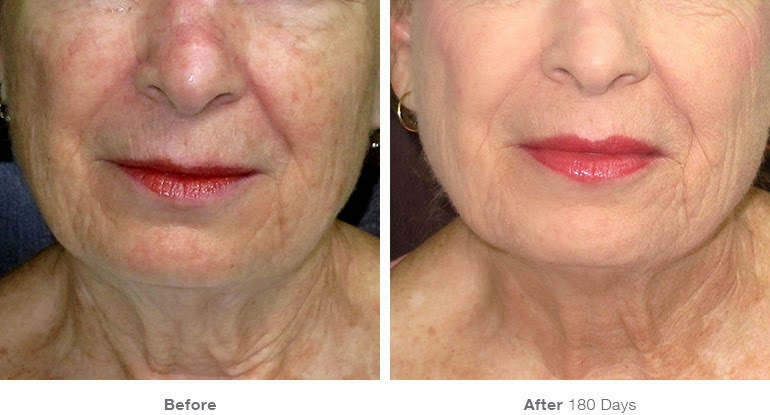 Perfect Body Laser and Aesthetics: Ultherapy at Perfect Body Laser