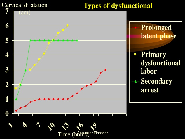 Med4yu: Primary Dysfunctional Labor