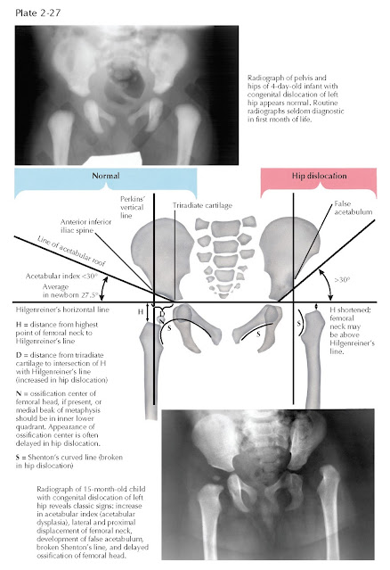 DEVELOPMENTAL DISLOCATION OF THE HIP - pediagenosis
