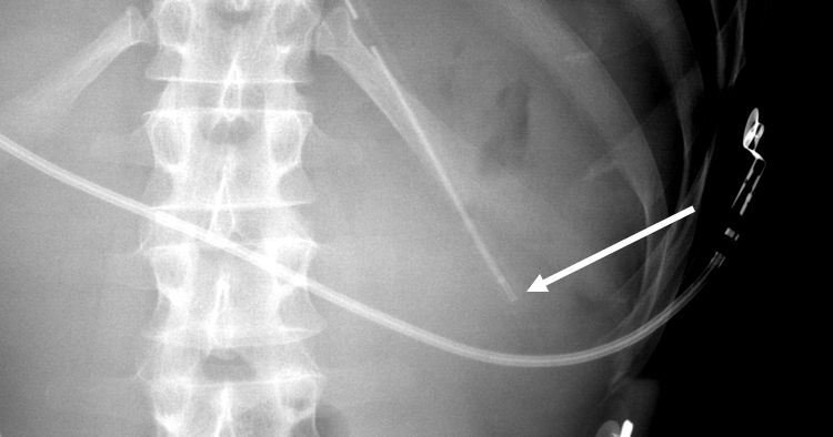 Roentgen Ray Reader: Edi Catheter (NOT MRI SAFE)