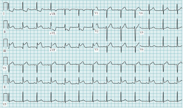 Acute Type A Aortic Dissection Case File