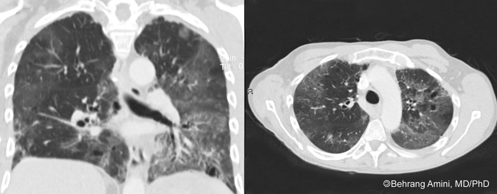 Roentgen Ray Reader: Peripheral Distribution of Pulmonary Opacities