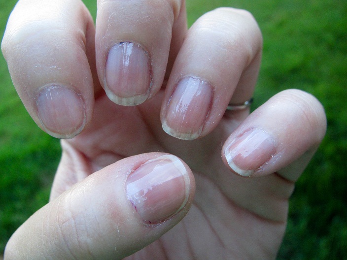 Nibble Files: A Nail Biter's Blog: Progress (Warning: Ugly Nails)