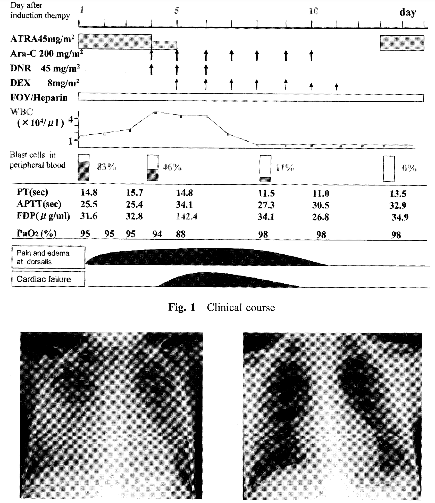 松下 ER ランチ・カンファレンス: ATRA （ アトラ ） 症候群（All-trans retinoic acid syndrome)