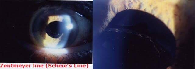 Ophthalmology Notes: Lines in Ophthalmology