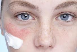 How to treat skin rash and face rash: 2012