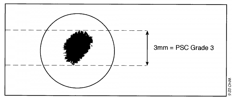 Ophthalmology Notes: Cataract Grading WHO 2002