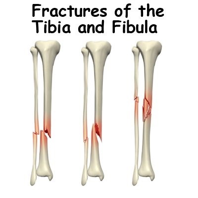 Types & Symptoms of Fibula Fractures - My Poll Ux - Internet of things