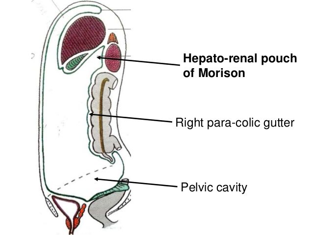 easyhumanatomy: Summary of Hepato-renal recess/ Pouch of Morison