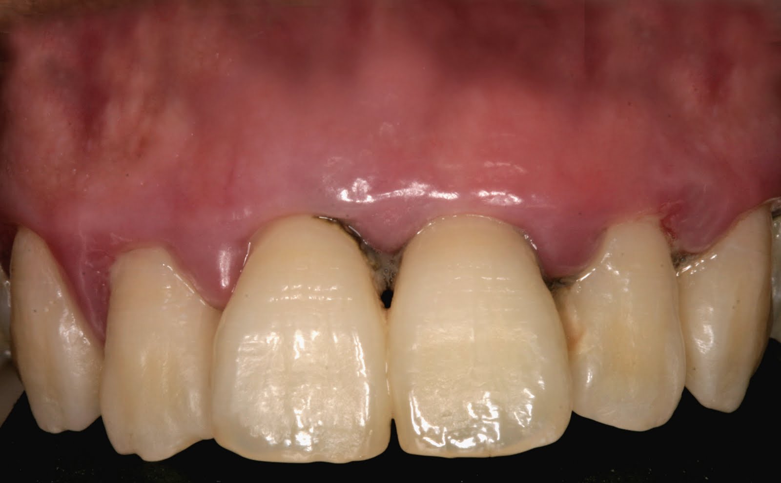 Periodontite; Pericementite