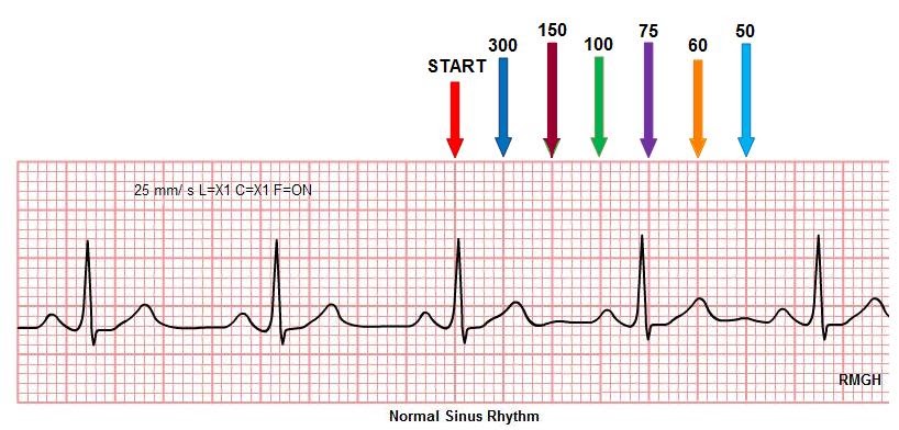 Learning how to read electrocardiograms (EKGs): Can we calculate the rate?