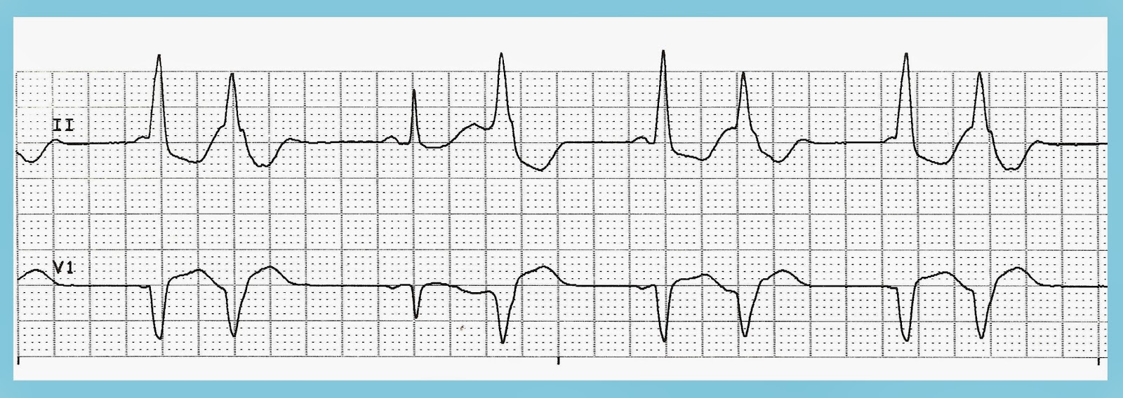 EKG Rhythm Quiz 276