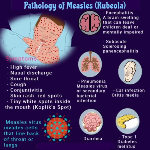 Pathology of Measles