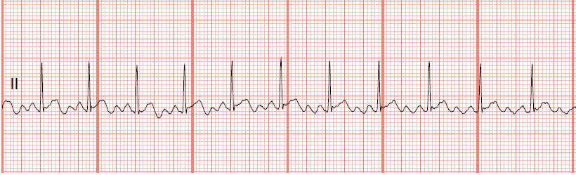 Basic EKG Rhythm Test 40