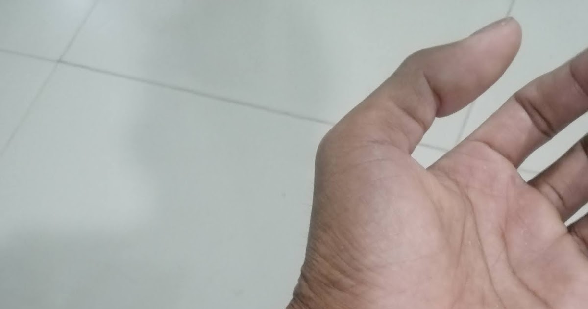 Pengalaman Prosedur Persiapan dan Pasca Operasi Hemoroid (Ambeien ...