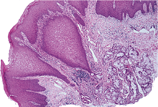 ابتسامة مشرقة : التهاب الفم النيكوتيني ( Nicotine stomatitis )