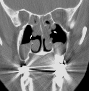 Nasal Polyps - Symptoms, Causes, Treatment, Surgery (Removal)