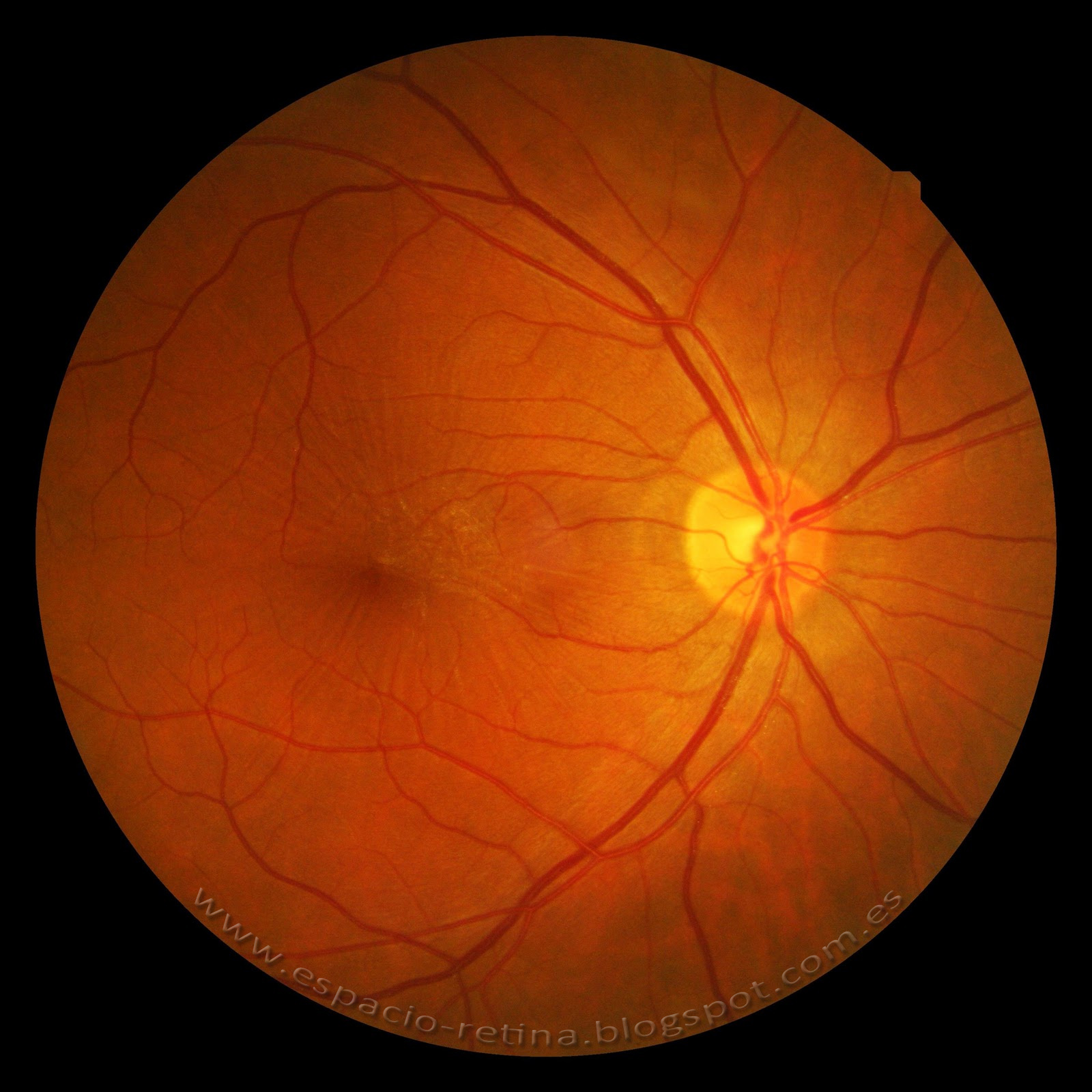 ESPACIO RETINA: Membrana epirretiniana macular.