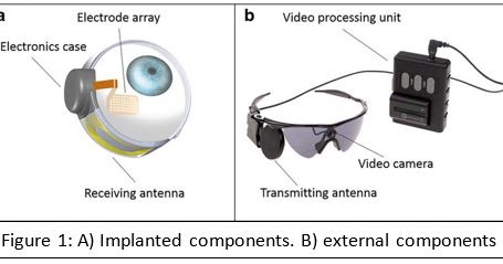 Bionic Eye - from sci-fi to reality…