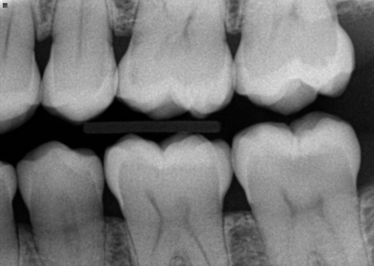 sweet tooth: deceiving caries