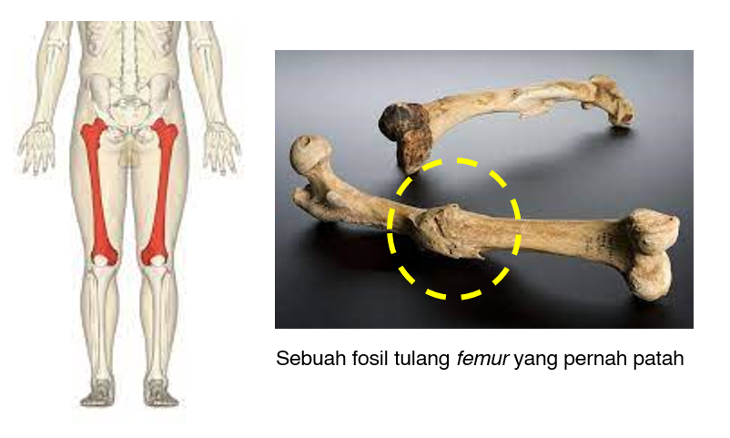 Tulang Patah dan Tanda Peradaban Pertama