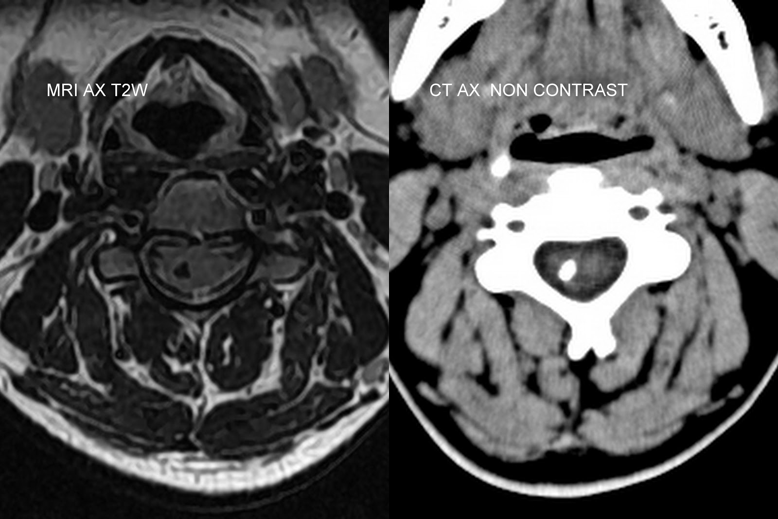 Dr Balaji Anvekar Frcr Nodular Calcification Spinal Cord