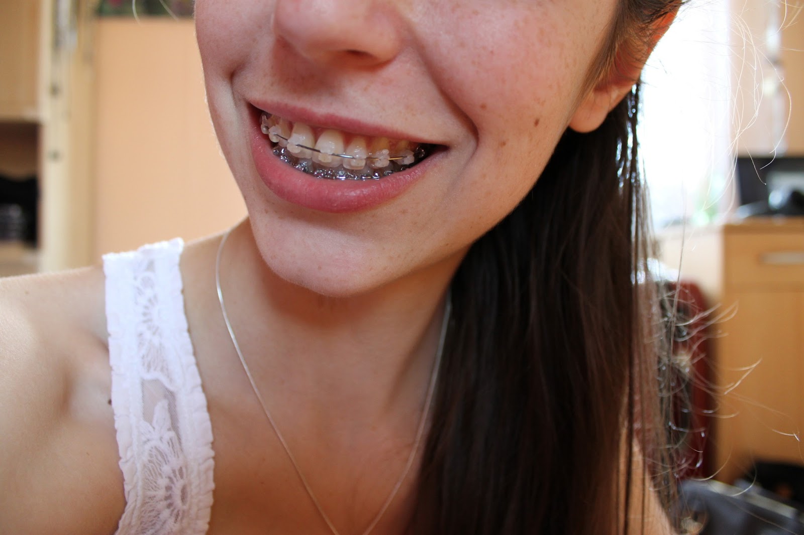 Blaubeer Blip: Short Update: Meine Zahnspange und Ich Blaubeer Blip: Short Update: Meine Zahnspange und Ich
