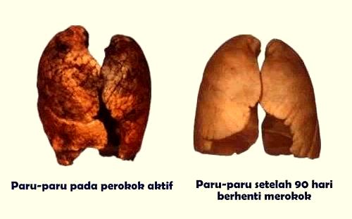 Cara Mencegah Penyakit Kanker Paru-Paru Pada Pria ~ Cara Mencegah ...