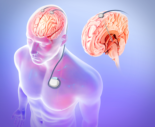 Deep Brain Stimulation Treatment Cost in India - Parkinsons.co.in