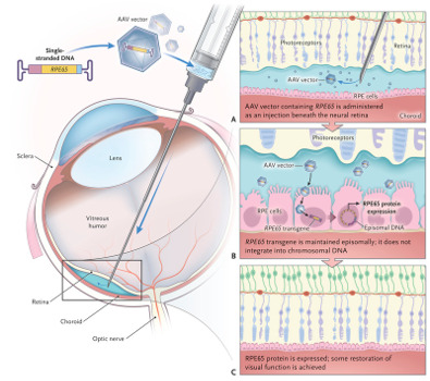 Luxturna e Retinite Pigmentosa: promessa mantenuta! - NoisyVision