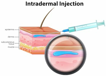 nursing study notes: Intradermal injection