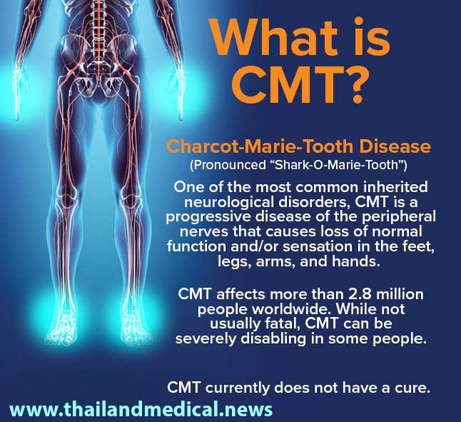 What Is Charcot-Marie-Tooth Disease Type 1A at Max Redfern blog