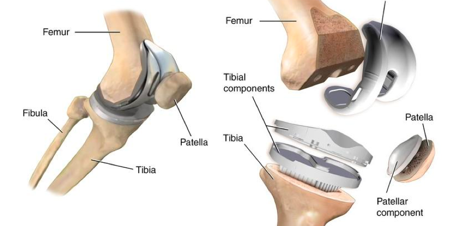 Welke soorten knieprotheses bestaan er?