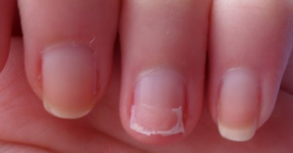 Best Home Remedies to Cure Splitting Nails - Best Homemade Tips