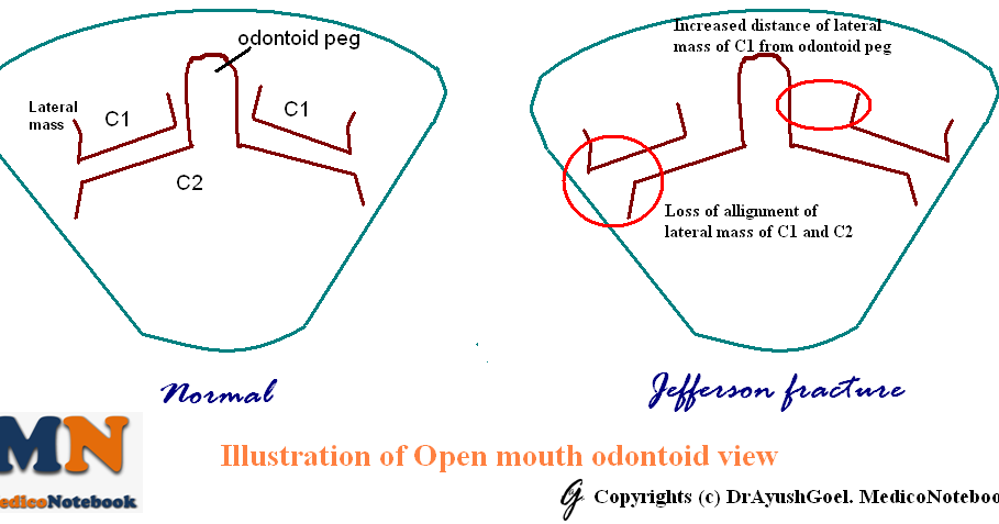 MedicoNotebook: Jefferson fracture