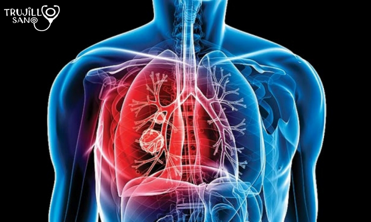 TRUJILLO SANO: CONOCE MÁS SOBRE LA TBC