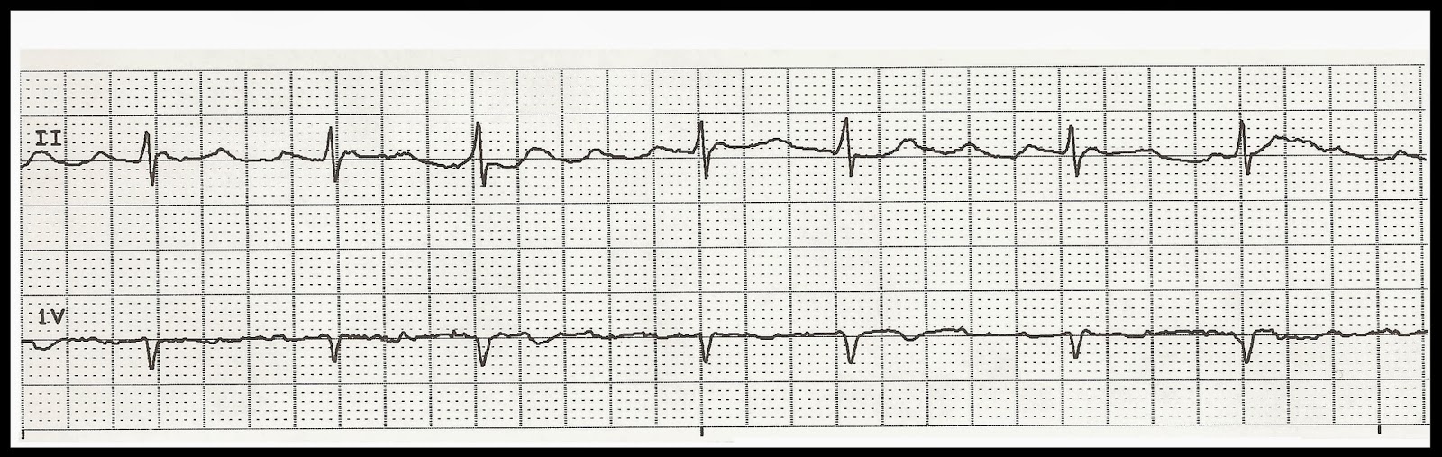Sinus Tachycardia Vs Atrial Flutter