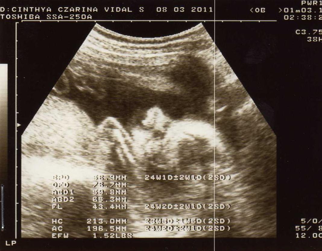 Sophia Fernanda (frijolita): 23 semanas