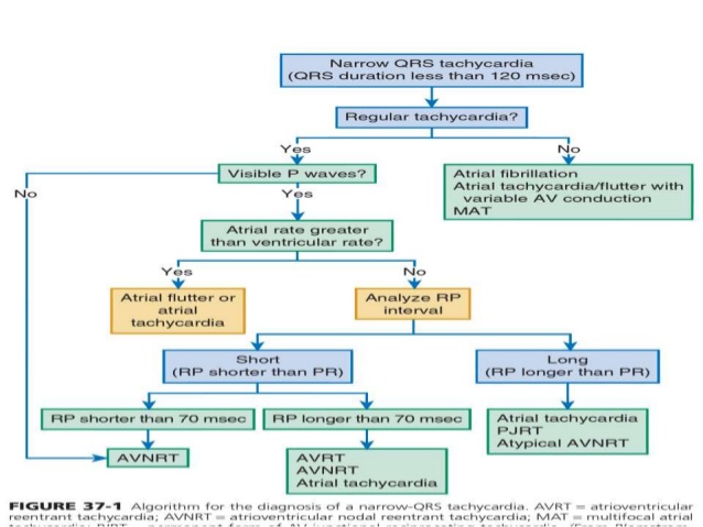 Cardiology window: PSVT (AVNRT)