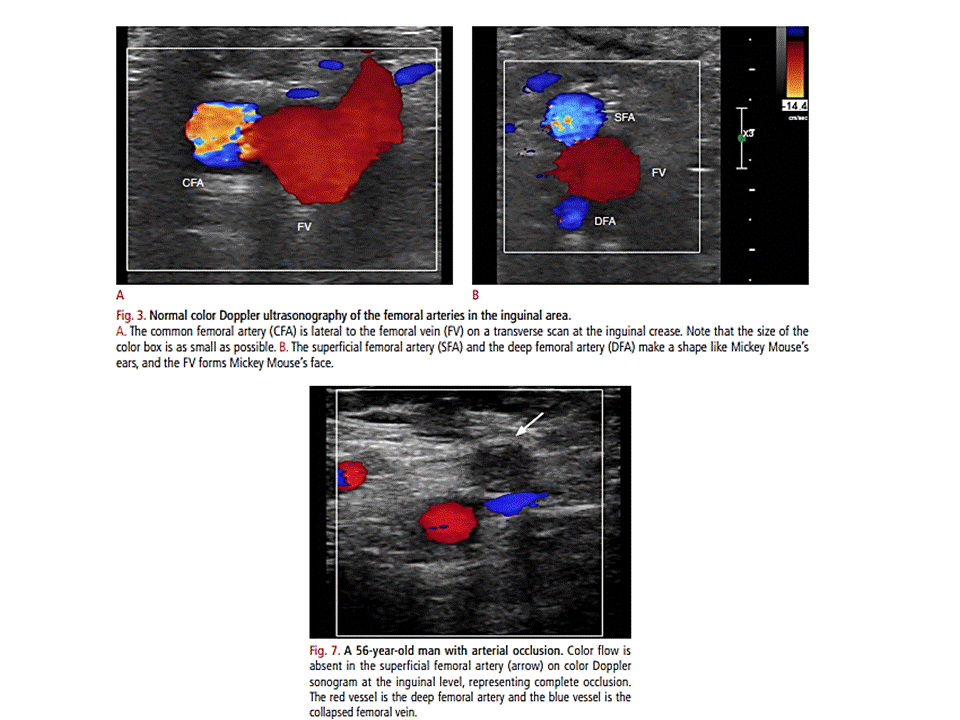 BÀI SOẠN VỀ SIÊU ÂM CHẨN ĐOÁN: Doppler Ultrasonography of the Lower ...