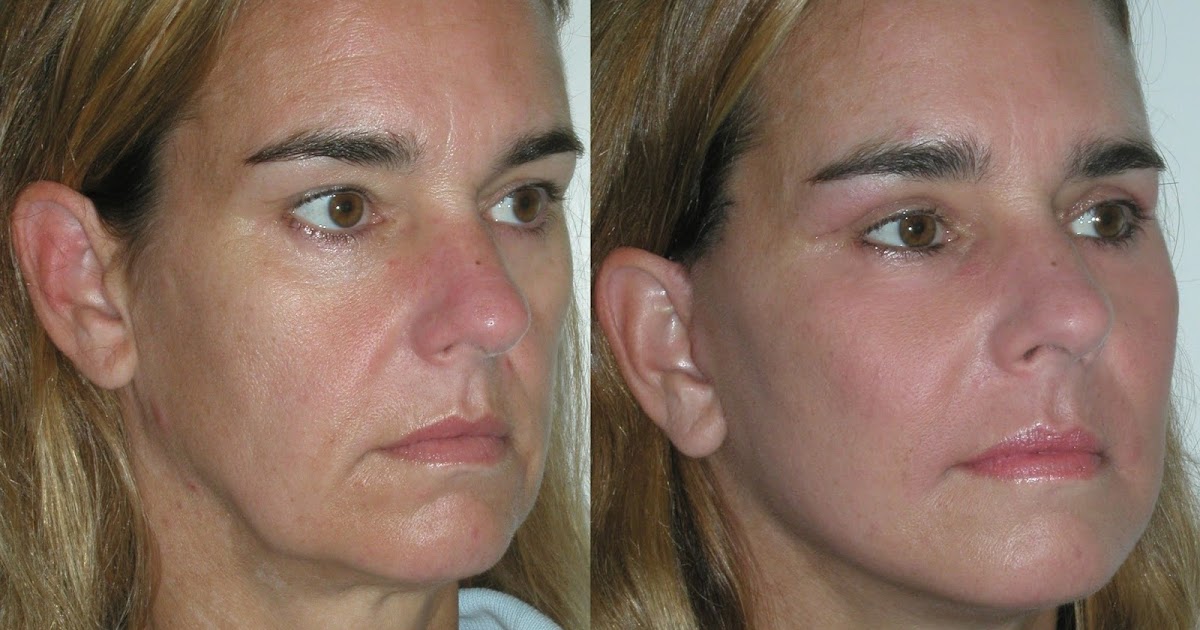 Facial Exercises Produce Gorgeous Natural Facelifts For Men And Women ...